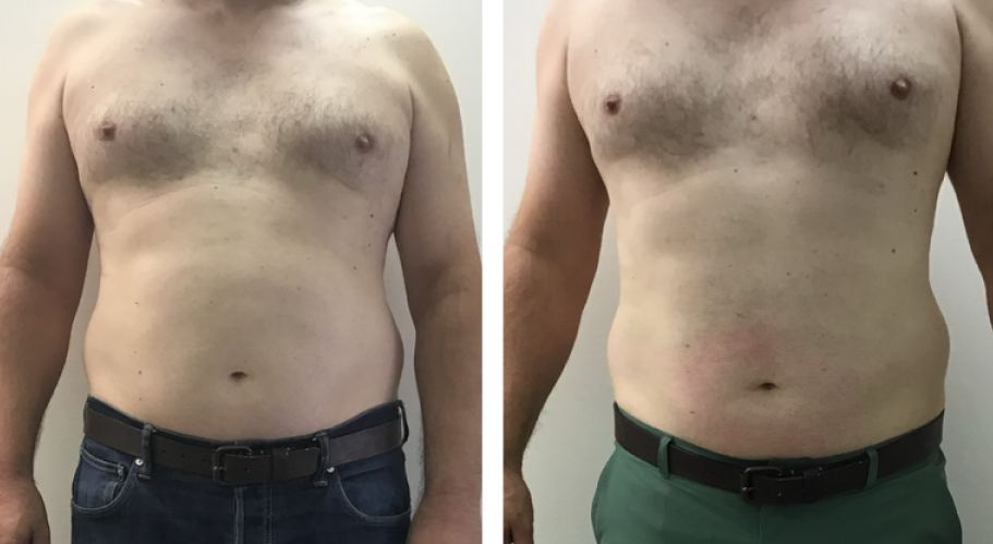 Non Surgical Fat Loss For Men - Charisma Beauty, Skincare & Aesthetics